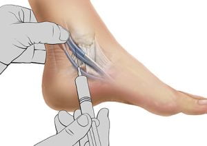 NYC Ankle Injection Doctors | Top Ankle Pain Specialists in New York