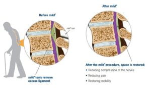 MILD Procedure in NYC | Spine Doctors Specialists New York