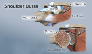 Shoulder Bursitis Treatment in NYC | Shoulder Bursitis Doctors Specialists