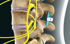 Vertiflex Procedure in NYC | Pain Management NYC