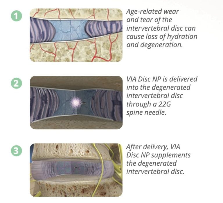 Via Disc NP Allograft | Pain Management NYC