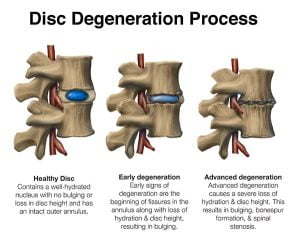 Via Disc NP Allograft | Pain Management NYC