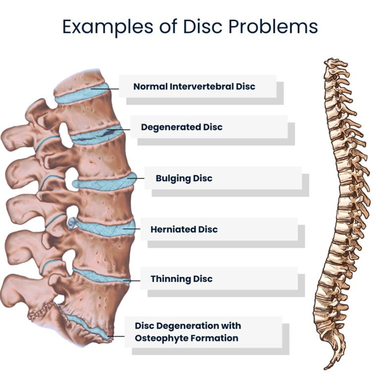 Back Pain Treatment in New York | Back Pain Doctors NYC