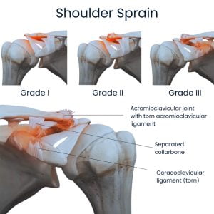 Shoulder Sprain & Strain Treatment in NYC | Doctor for Sprain and Strain
