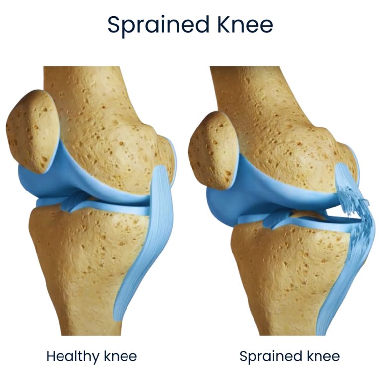 Sprained Knee Treatment NYC | Knee Pain Doctors, New York Specialists