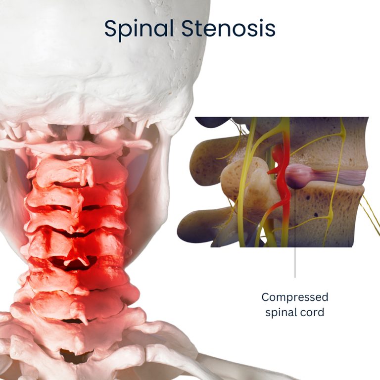 Neck Stenosis Treatment NYC | Pain Management NYC