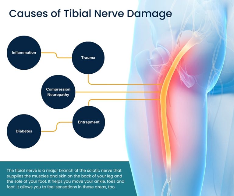 Tibial Nerve Damage Treatment NYC | Pain Management NYC