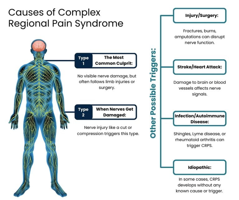 Complex Regional Pain Syndrome (CRPS) Treatment NYC