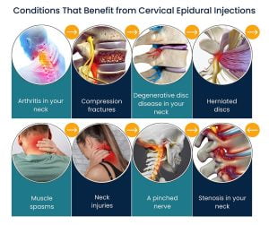 Cervical Epidural Steroid Injections NYC | Neck Pain Relief