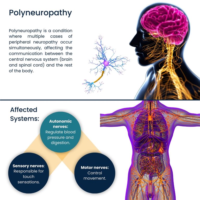 Polyneuropathy Treatment NYC | Pain Management NYC