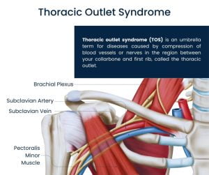Thoracic Outlet Syndrome Treatment NYC | Pain Management NYC