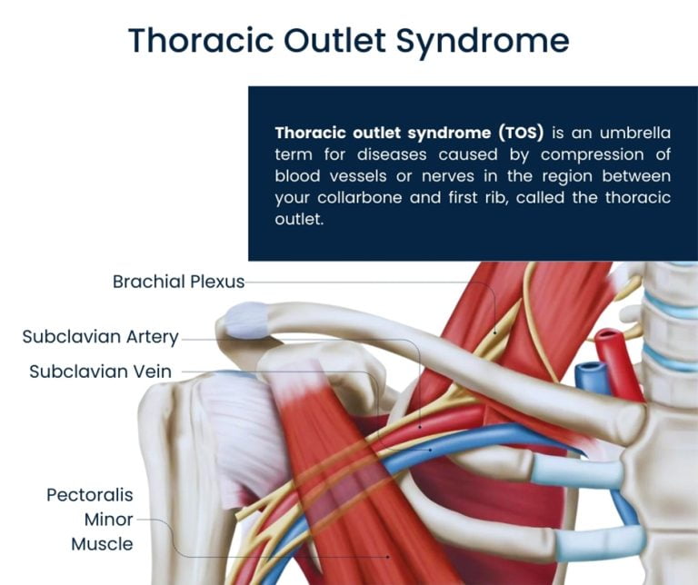 Thoracic Outlet Syndrome Treatment NYC | Pain Management NYC