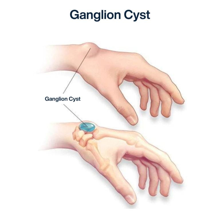 What Is a Ganglion Cyst? And Other Common Questions | Pain Management NYC