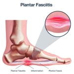 ¿Por qué me duele el talón? 5 causas principales - Pain Management NYC