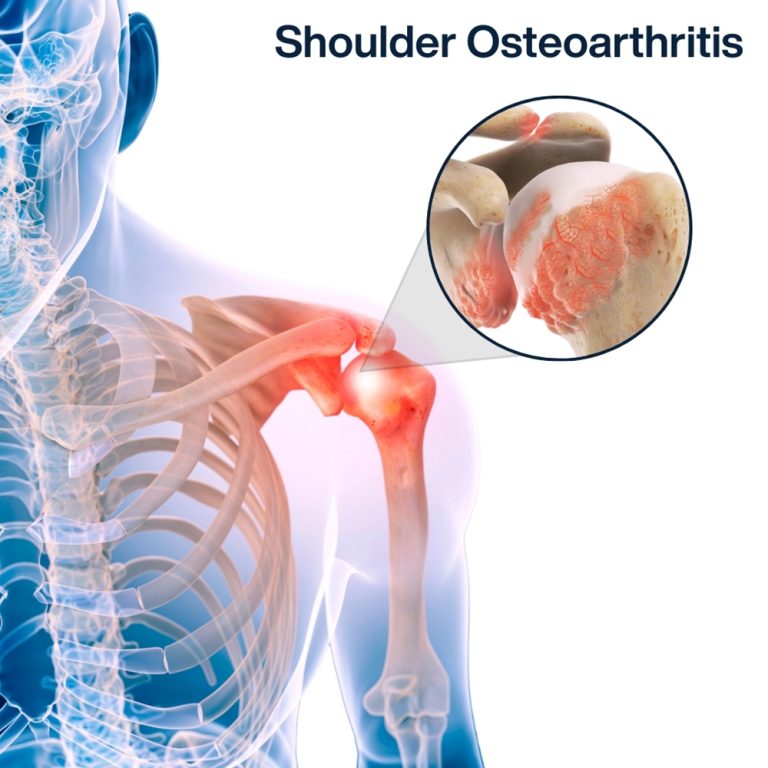 What Causes Sudden Shoulder Pain Without Injury? | Pain Management NYC