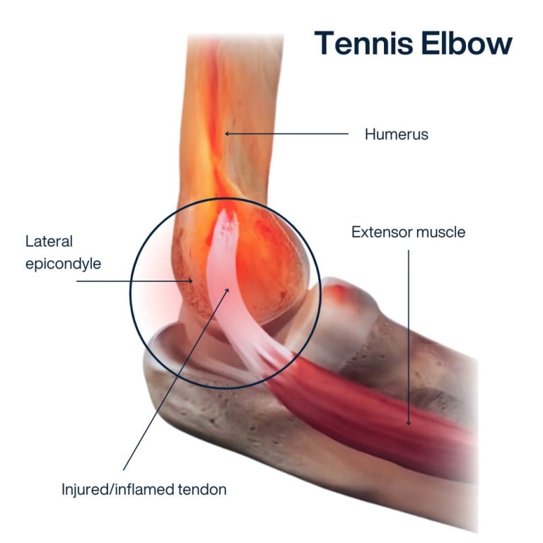 ¿Dolor en el codo al estirar el brazo? 7 Posibles Causas | Pain Management NYC