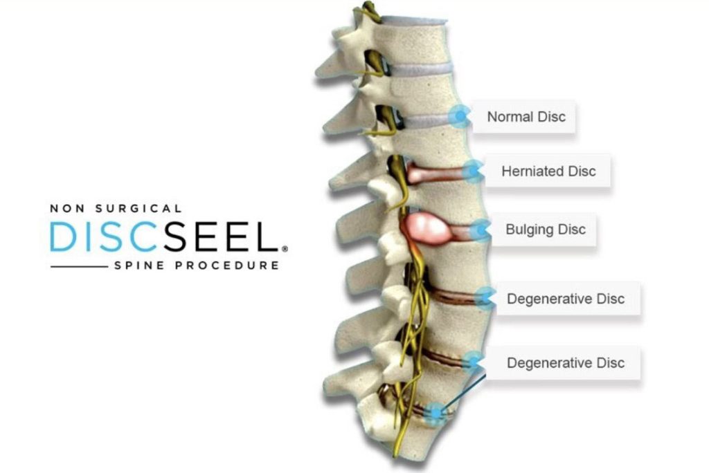 El procedimiento DISCSEEL® | Pain Management NYC