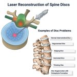 Laser Reconstruction of Spine Discs in NYC | Laser Disc Decompression